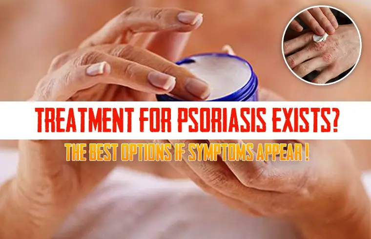 Treatment for psoriasis exists? The best options if symptoms appear ...